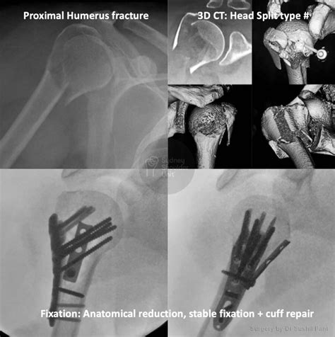Proximal Humerus Repair Medical Case Study Sydney Shoulder Unit