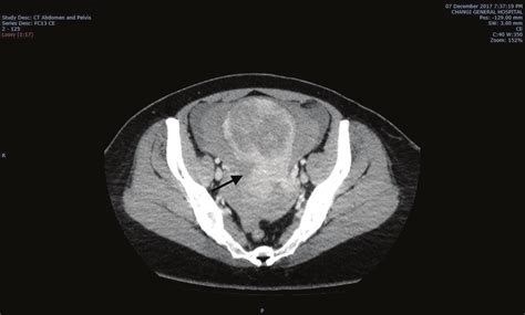 Ct Image Showed Hemoperitoneum With Source Of Bleeding Arising From A