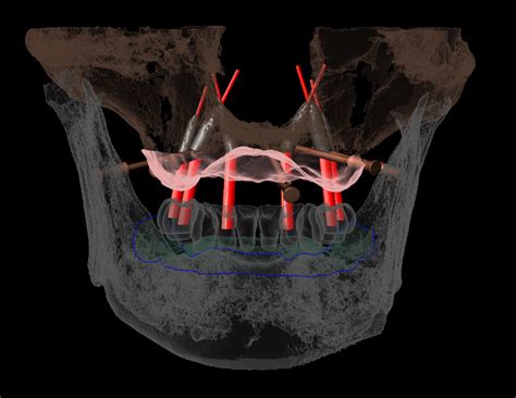 Surgical Guides Successful Procedures Our Products Apex Dental