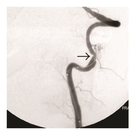 Ct A Showed Lamellar Infarct In The Pons And Worm Of Cerebellum And