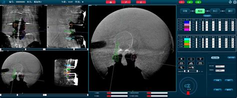 Posterior Fusion For Lumbar Scoliosis Assisted With Perlove Medicals