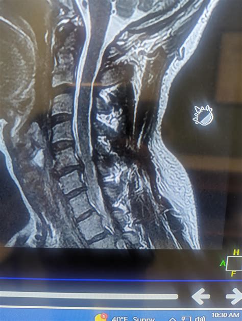 Cervical Spine Abnormalities In Late 30s Female Interpretation From A