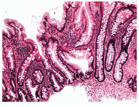 Colorectal Polyps Abdominal Key