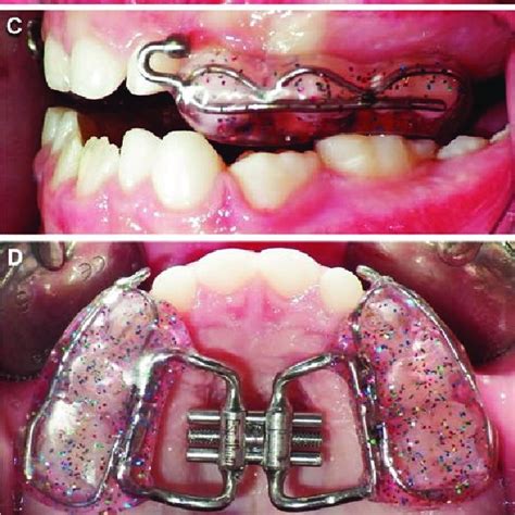 Pushing Splint Appliance In Frontal Intraoral A Left Side