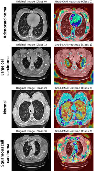 Ensemble Based Multiclass Lung Cancer Classification Using Hybrid Cnn