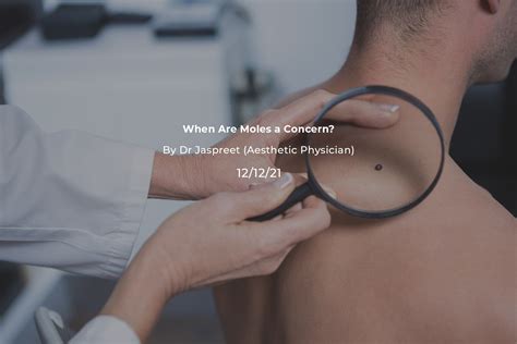 When Are Moles A Concern Stethohope Clinic