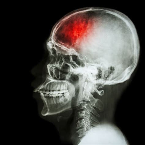 Reperfusing Large Core Stroke European Stroke Organisation