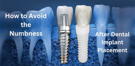 How To Avoid The Numbness After Dental Implant Specialist Placement