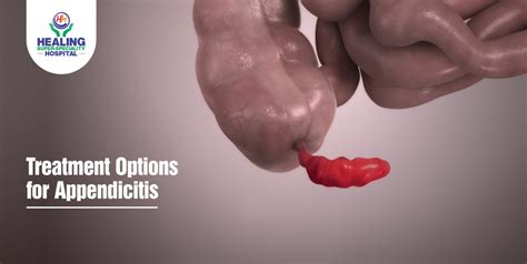 Treatment Options For Appendicitis Healing Hospital
