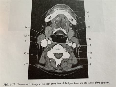 Ct Anatomy Of Hyoid Bone At Diane Arnett Blog