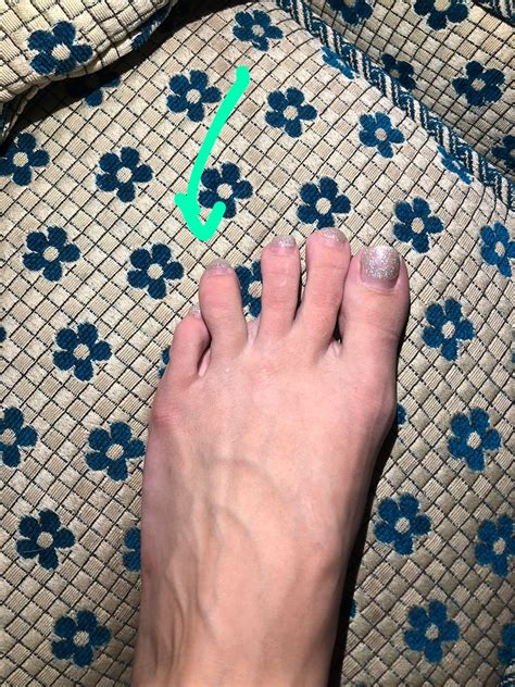 My Sister Broke Her Toe I Am Disgusted To Be Related To This Weak
