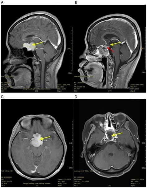 Case 2 Of Endoscopic Transsphenoidal Approach Patient 2 Was A