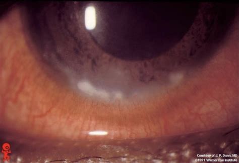 Corneal Disorders Flashcards Quizlet