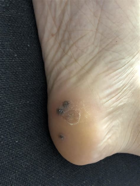 Bleomycin Round 1 Day 2 R Warts