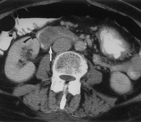 Ct Of The Duodenum An Overlooked Segment Gets Its Due Radiographics