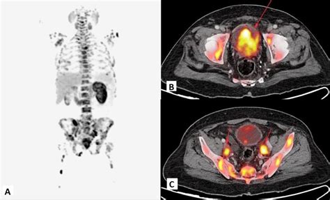 PSMA PET Scan Advanced Prostate Cancer Imaging In Mumbai India Picture This