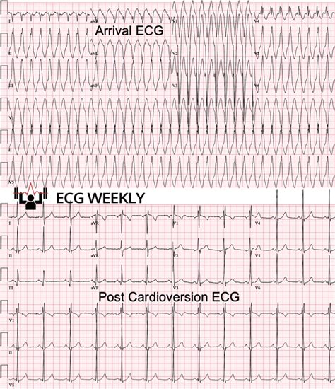 Wolff Parkinson White Wpw Syndrome With Supraventricular Tachycardia