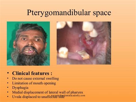 Infratemporal Space Infection