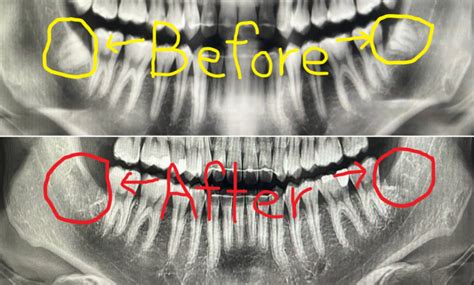 미금역 사랑니 전문 치과 찬스플란트 치과 타치과에서 뿌리만 남긴 매복 사랑니도 당일에 발치 가능합니다 네이버 블로그