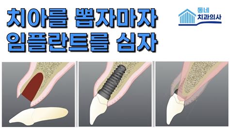 치아를 뽑자마자 임플란트를 심는 수술의 장단점 Youtube