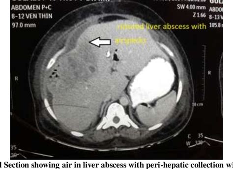 Metastatic Malignant Neoplasm In The Peritoneum Semantic Scholar