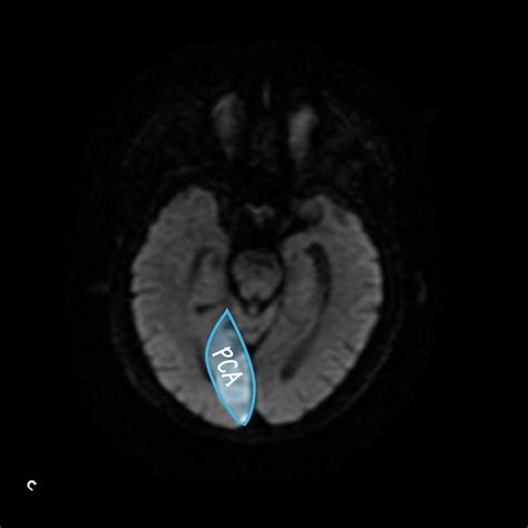 Neuroanatomy Glossary Posterior Cerebral Artery Pca Stroke Ditki Medical And Biological Sciences