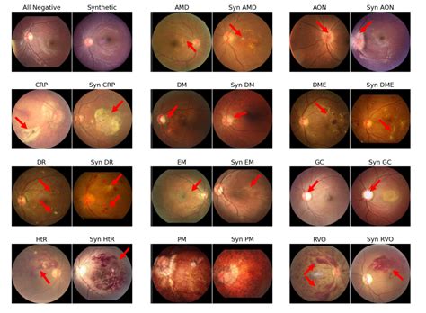Synfundus 1m【大而全 被震惊到了】12个类别、100多万张视网膜数据集 眼底血管类疾病数据集 Csdn博客