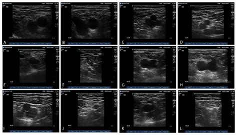 Point Of Care Ultrasound Screening For Proximal Lower Extremity Deep
