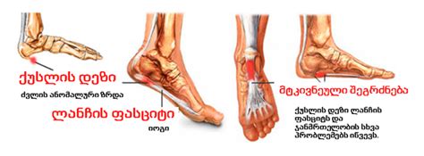 ვმკურნალობთ ქუსლის დეზს ეფექტური შინაურული რეცეპტები რჩევები ვივიენისგან