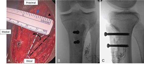 Tibial Tubercle Osteotomy In The Adolescent Patient Journal Of The