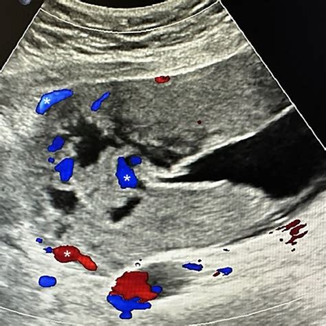 Left Sagittal Color Doppler Imaging Depicting Similar Findings As