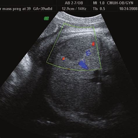 Abdominal Computed Tomography Revealed A Heterogeneous Enhancing Mass