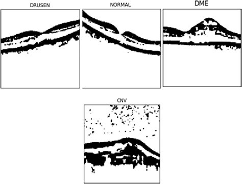 Segmented Retinal Structure Results Download Scientific Diagram