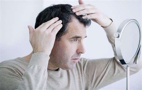 Haaruitval Door Alopecia Digitale Etalagesnl