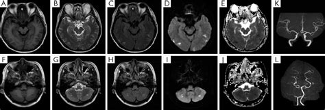 Pdf Acute Cerebral Infarction Caused By Cardiac Subvalvular Thrombus