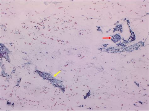 Atlas Of Breast Cancer Early Detection