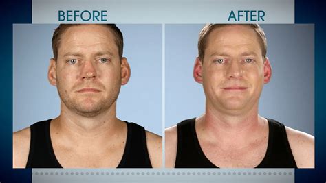 No Your Daughters Nose From Botched Patients Before And After