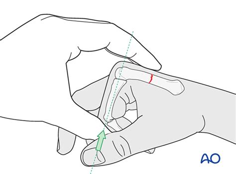 Compression Plating For Simple Transverse Fracture Of The Diaphysis