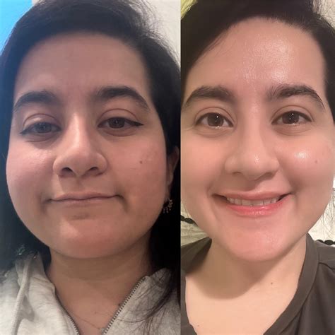 Lip Flip Masseter Botox Before And After 4 Days Post R