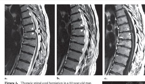 Figure 2 From Imaging Of Idiopathic Spinal Cord Herniation Semantic