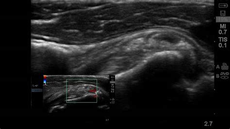 Subscapularis Calcification Youtube