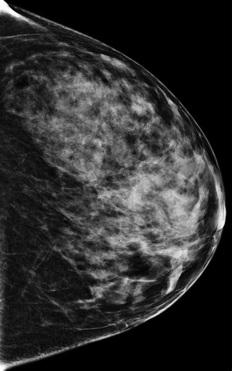 Grouped Calcifications Radiology Key