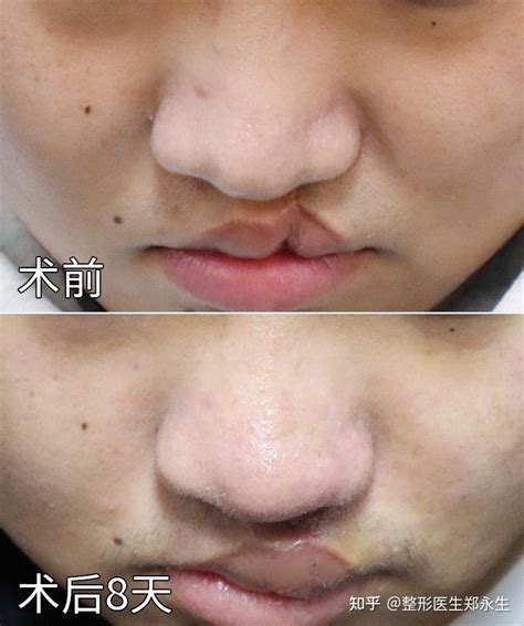 山西男孩学习成绩非常好，唇腭裂20多年，毕业前终于修复圆梦 知乎