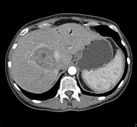 Cholangiocarcinoma With Stent Liver Radiology Case Studies Ctisus