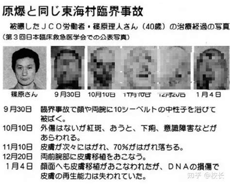 83天，一个壮汉变成一堆腐肉，核辐射惨烈堪比地狱 知乎