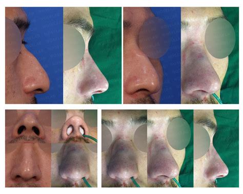 Closed Rhinoplasty Deviated Nose Hump Nose Hanging Nose