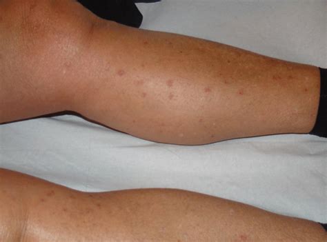 Diabetic Dermopathy 50 Download Scientific Diagram