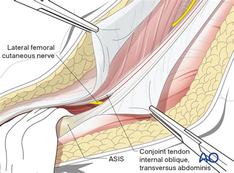 Ilioinguinal Approach