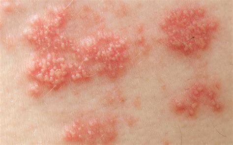 Science Direct Topics Shingles Itching Treatment