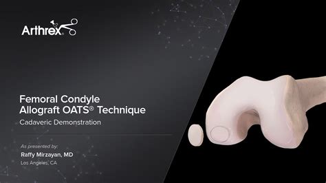Arthrex Femoral Condyle Allograft Oats® Technique